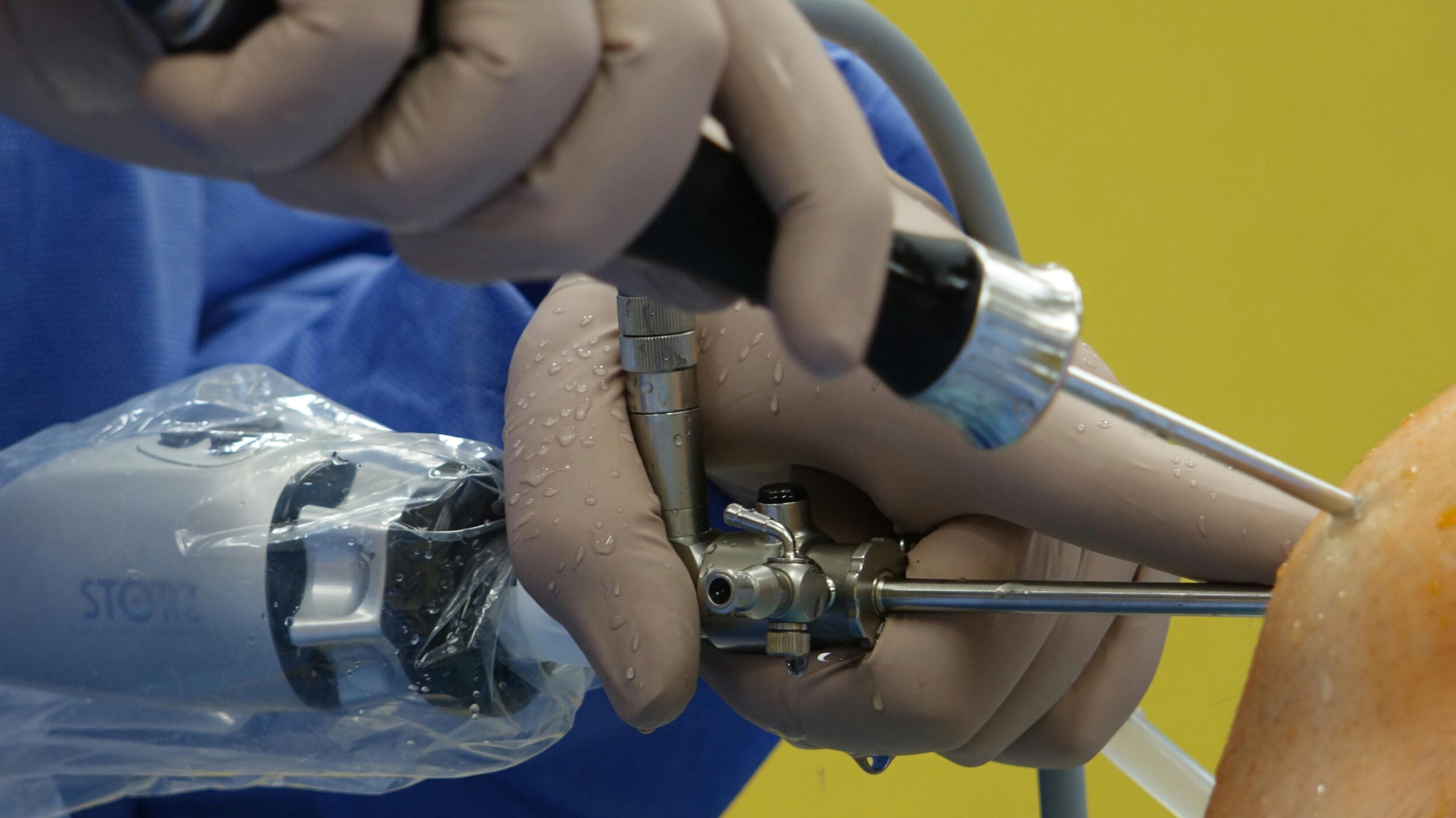 c-TIF — Expanding Minimally Invasive Options for GERD - Northwestern ...